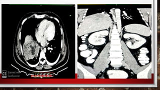ruptured liver abscess.pptx