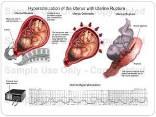 Obstetrics emergency ruptured uterus.ppt