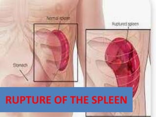 Ruptured Spleen Bruising