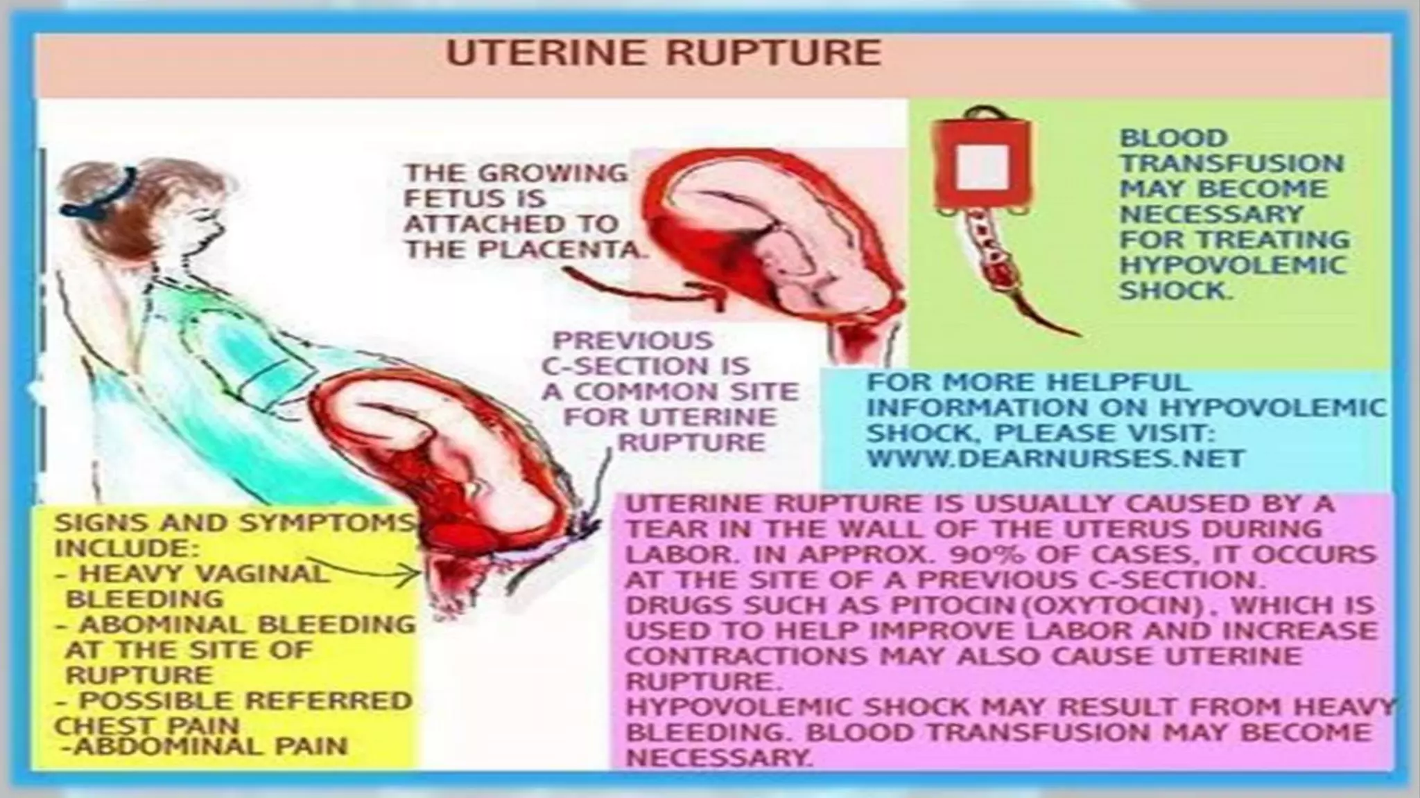 Rupture of the uterus | PPTX