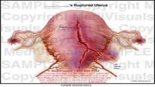 Rupture of the uterus | PPTX