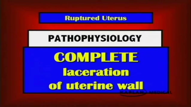 Rupture of the uterus | PPTX
