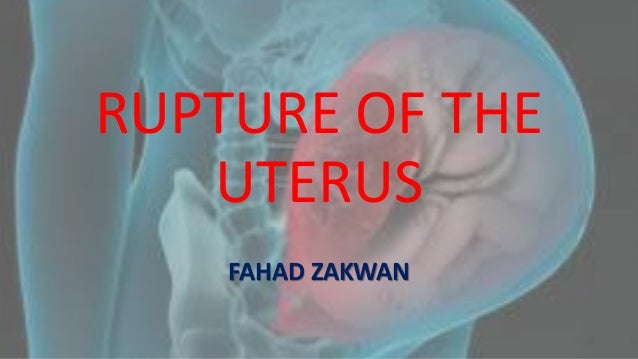 Rupture of the uterus