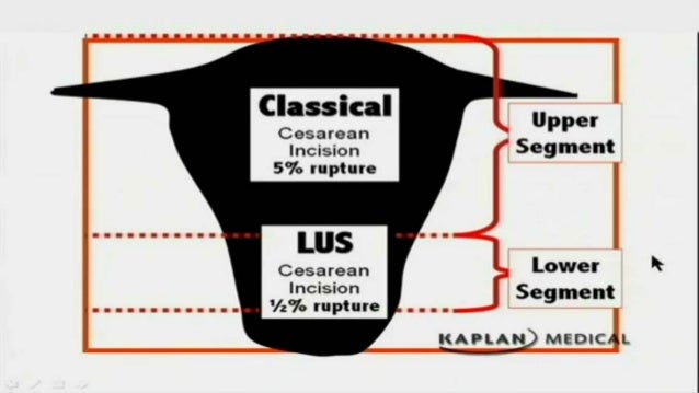 Complete Rupture Of Uterus
