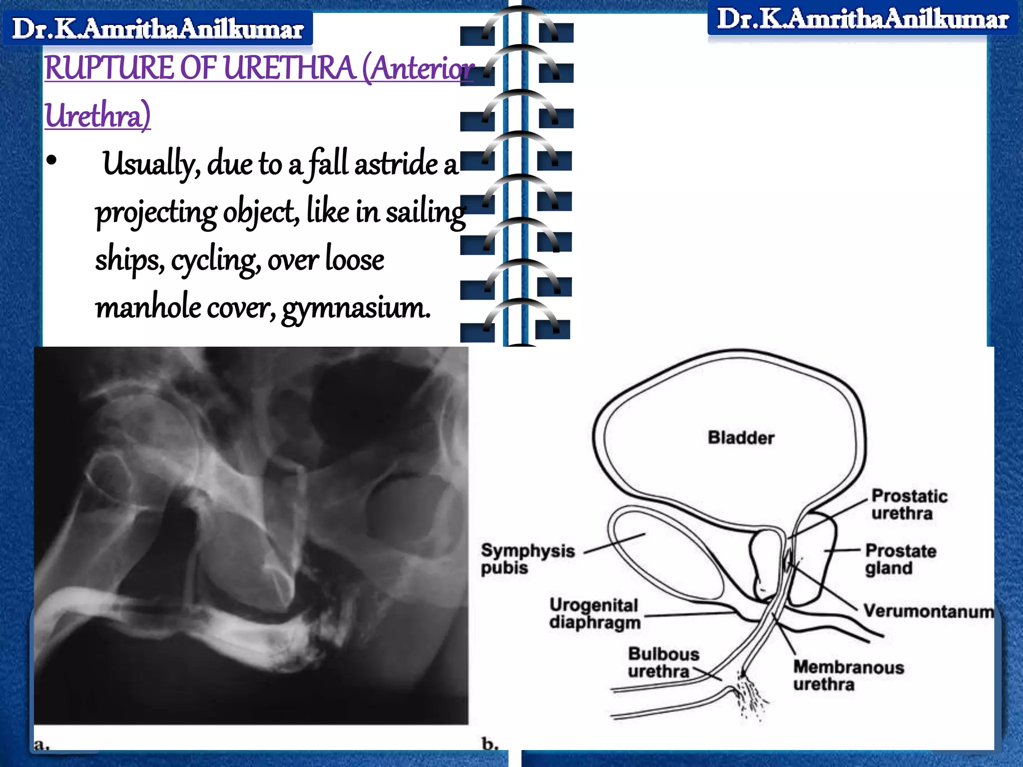 Rupture of urethra by Dr.K.AmrithaAnilkumar | PPTX
