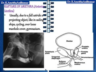 Rupture of urethra by Dr.K.AmrithaAnilkumar | PPTX