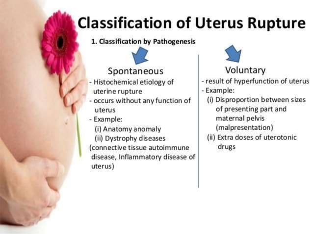 Rupture of uterus | PPTX | Pregnancy | Reproductive Health