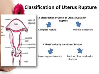Rupture of uterus | PPTX