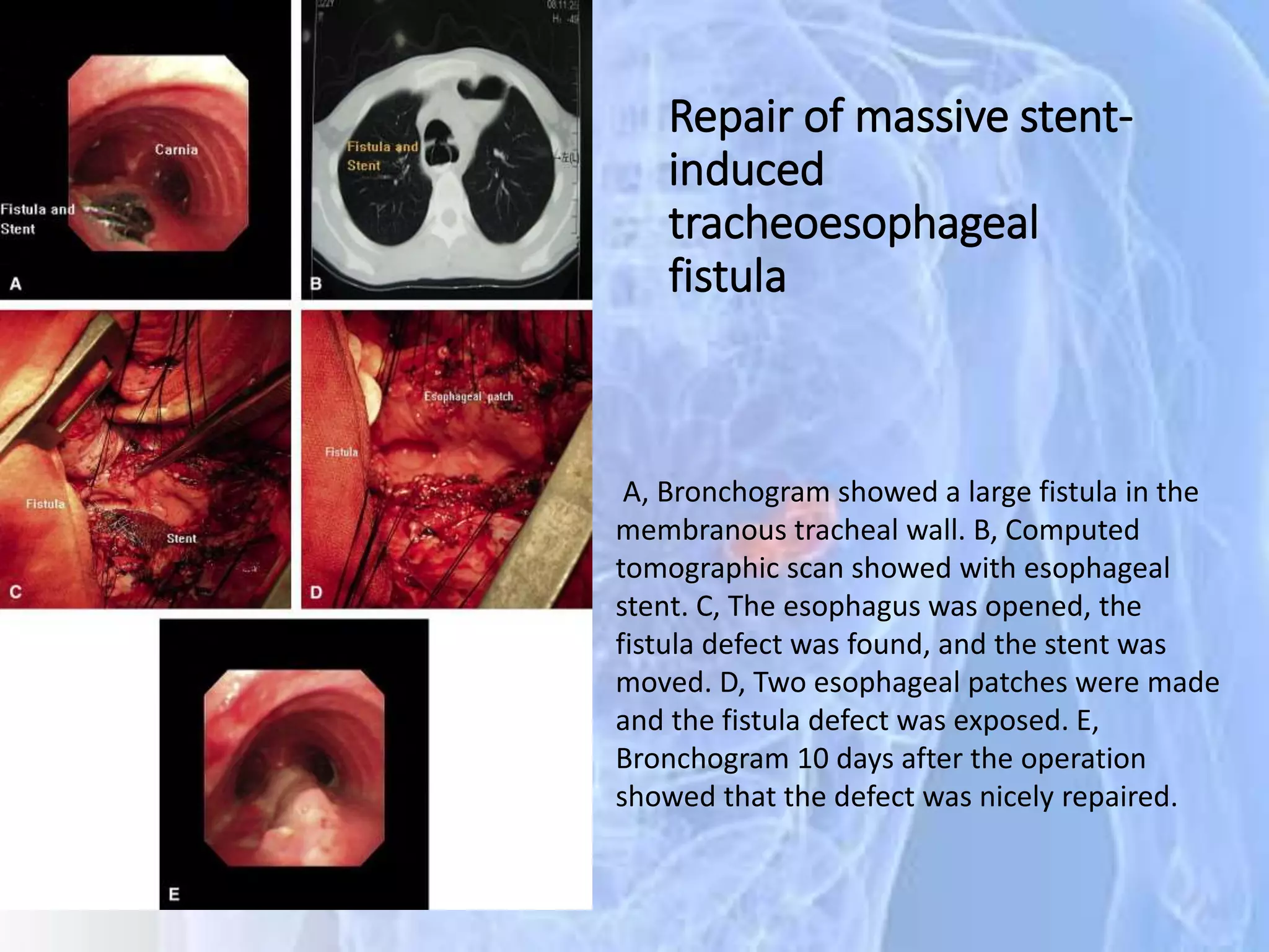 Ruptur esofagus&trauma hepar | PPTX