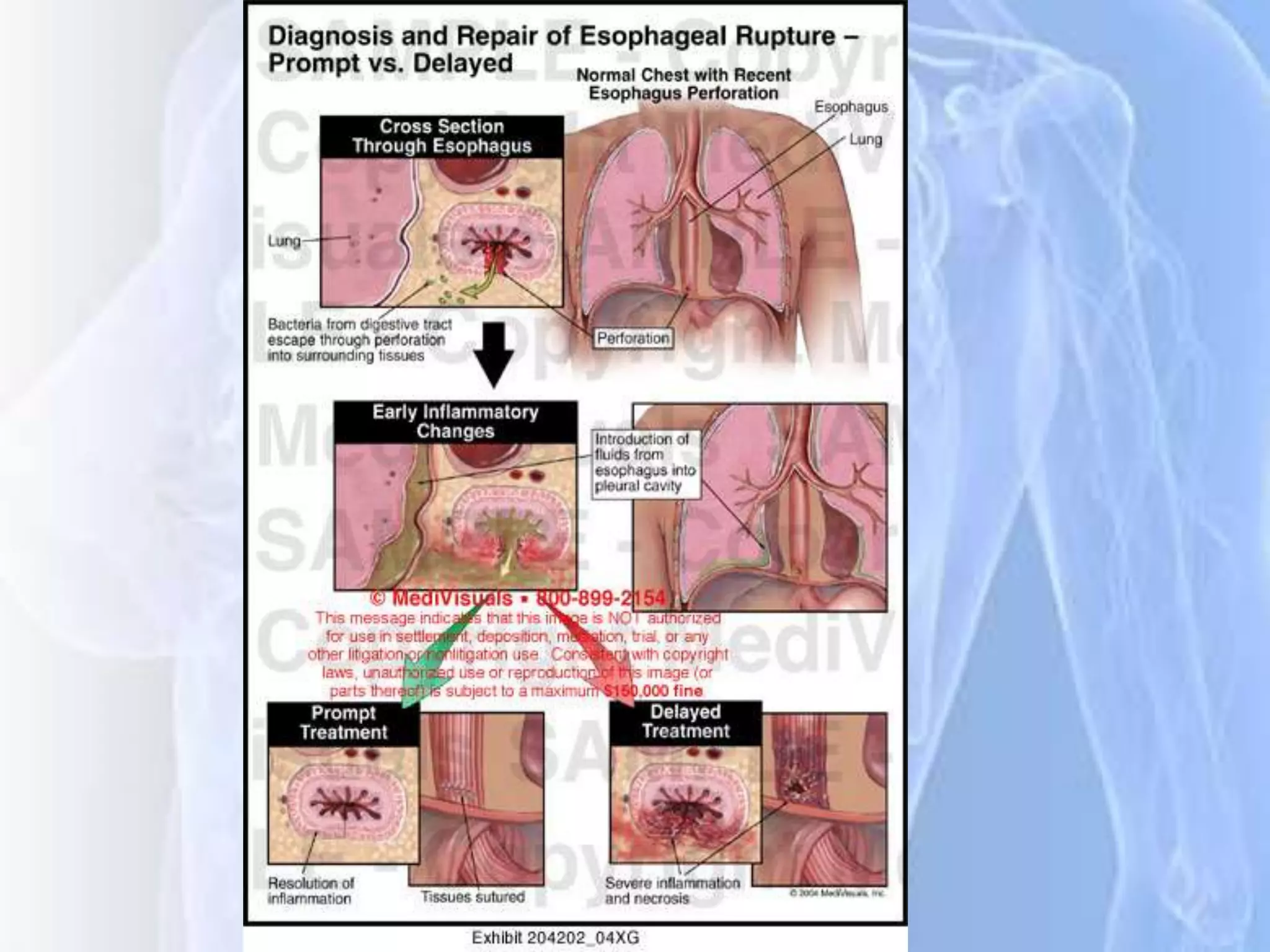 Ruptur esofagus&trauma hepar | PPTX