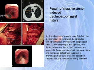 Ruptur esofagus&trauma hepar | PPT