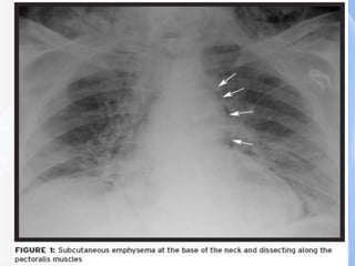 Ruptur esofagus&trauma hepar | PPT