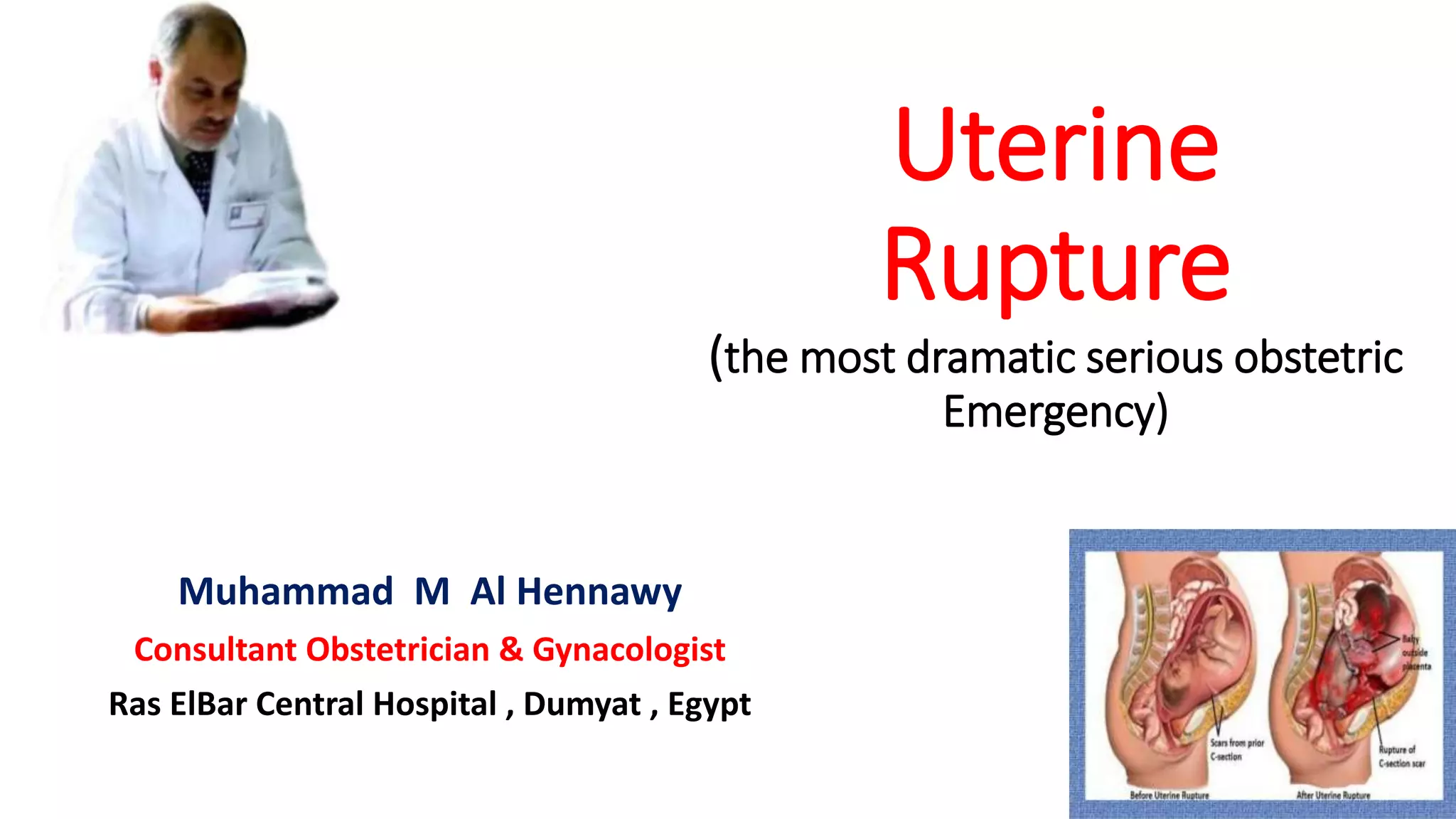 Rupture uterus | PPTX