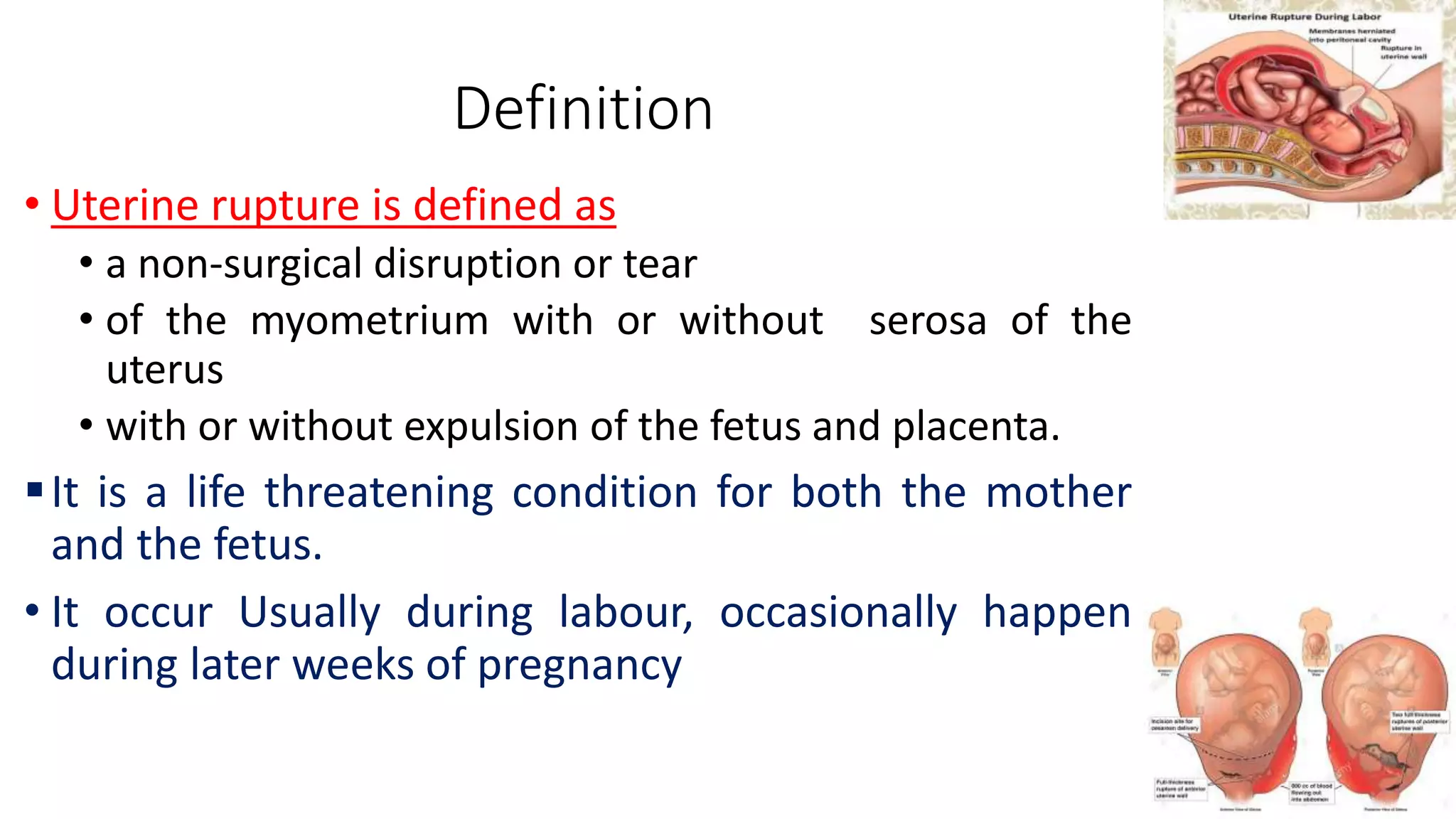 Rupture uterus | PPTX