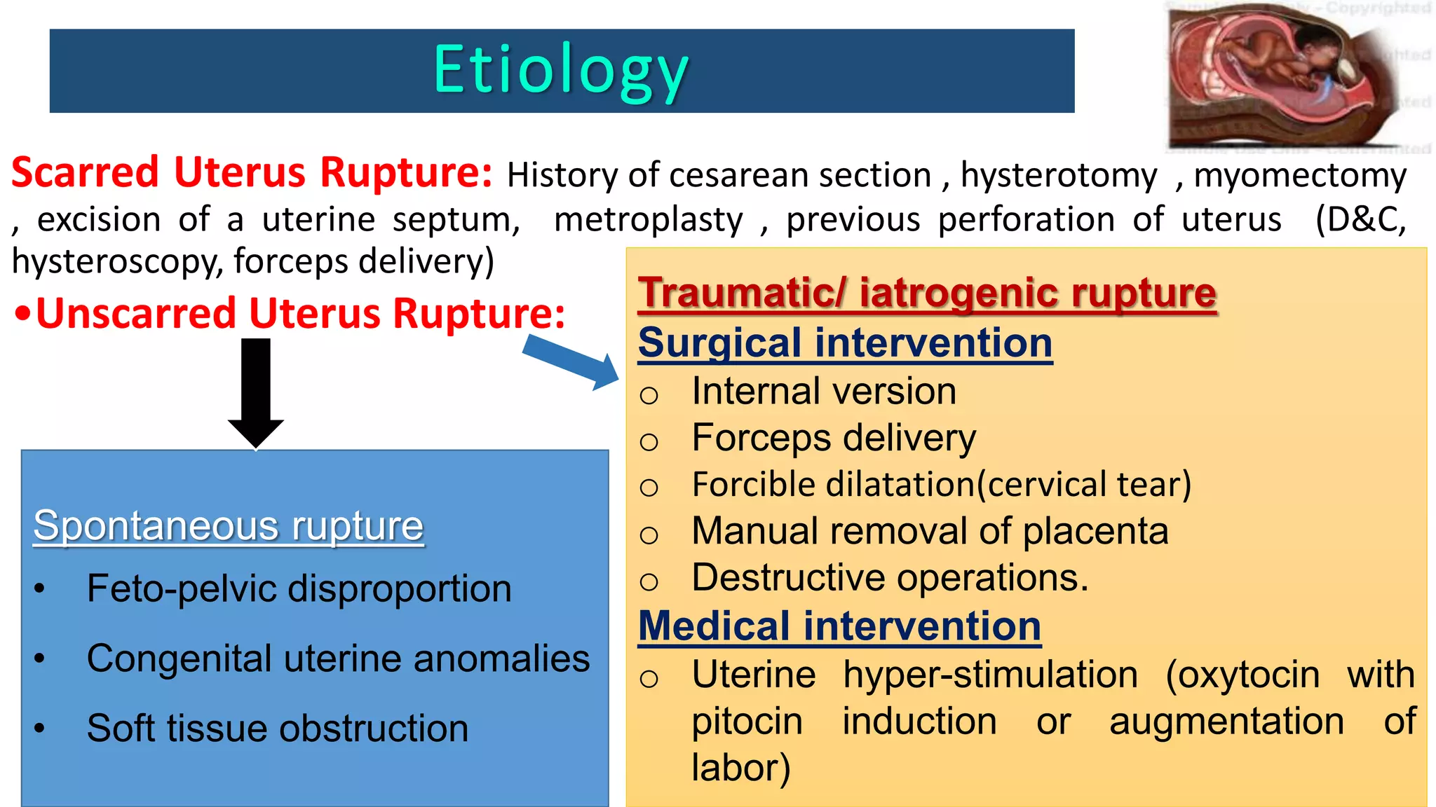 Rupture uterus | PPTX