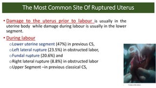Rupture uterus | PPTX