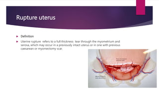 Rupture uterus.pptx