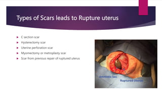 Rupture uterus.pptx