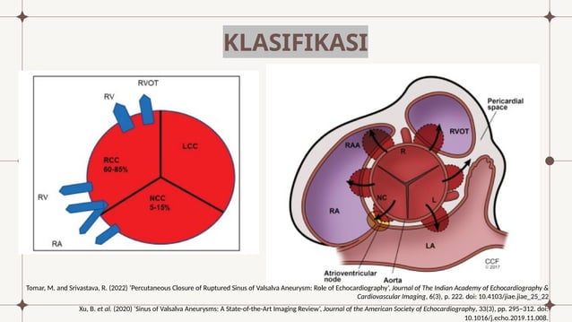 Ruptur Sinus Valsava dfdffdffCTP (1).pptx