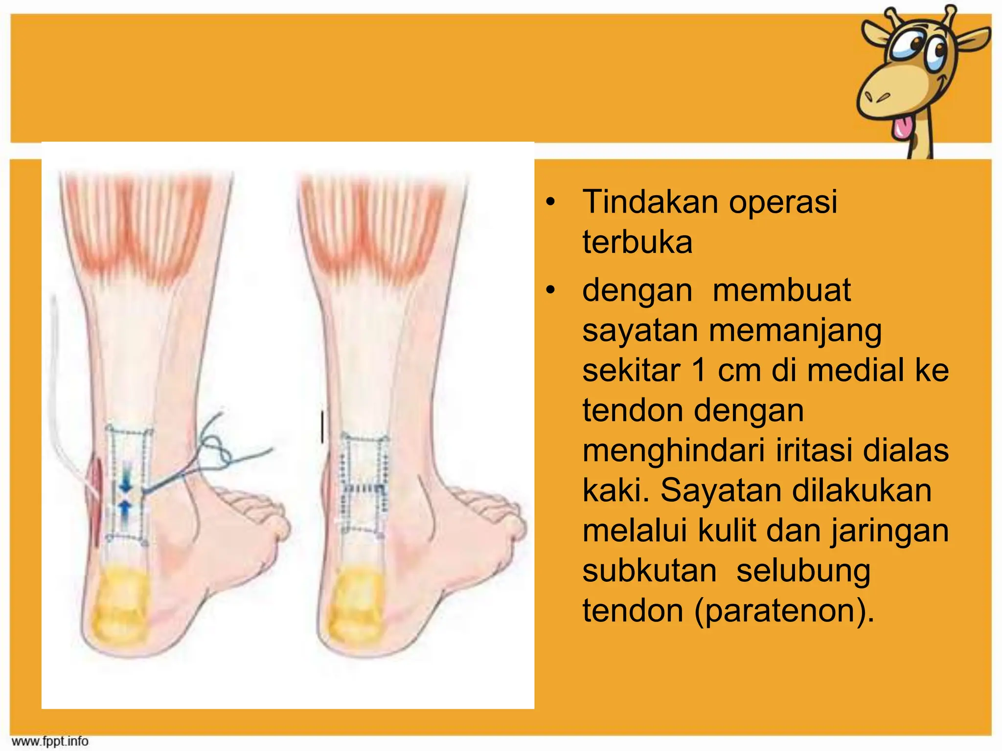 Ruptur_tendo_achilles.pptx biar bisa download ppt ya guys | PPT