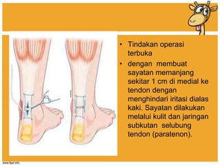 Ruptur_tendo_achilles.pptx biar bisa download ppt ya guys | PPT