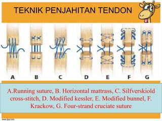 Ruptur_tendo_achilles.pptx biar bisa download ppt ya guys | PPT