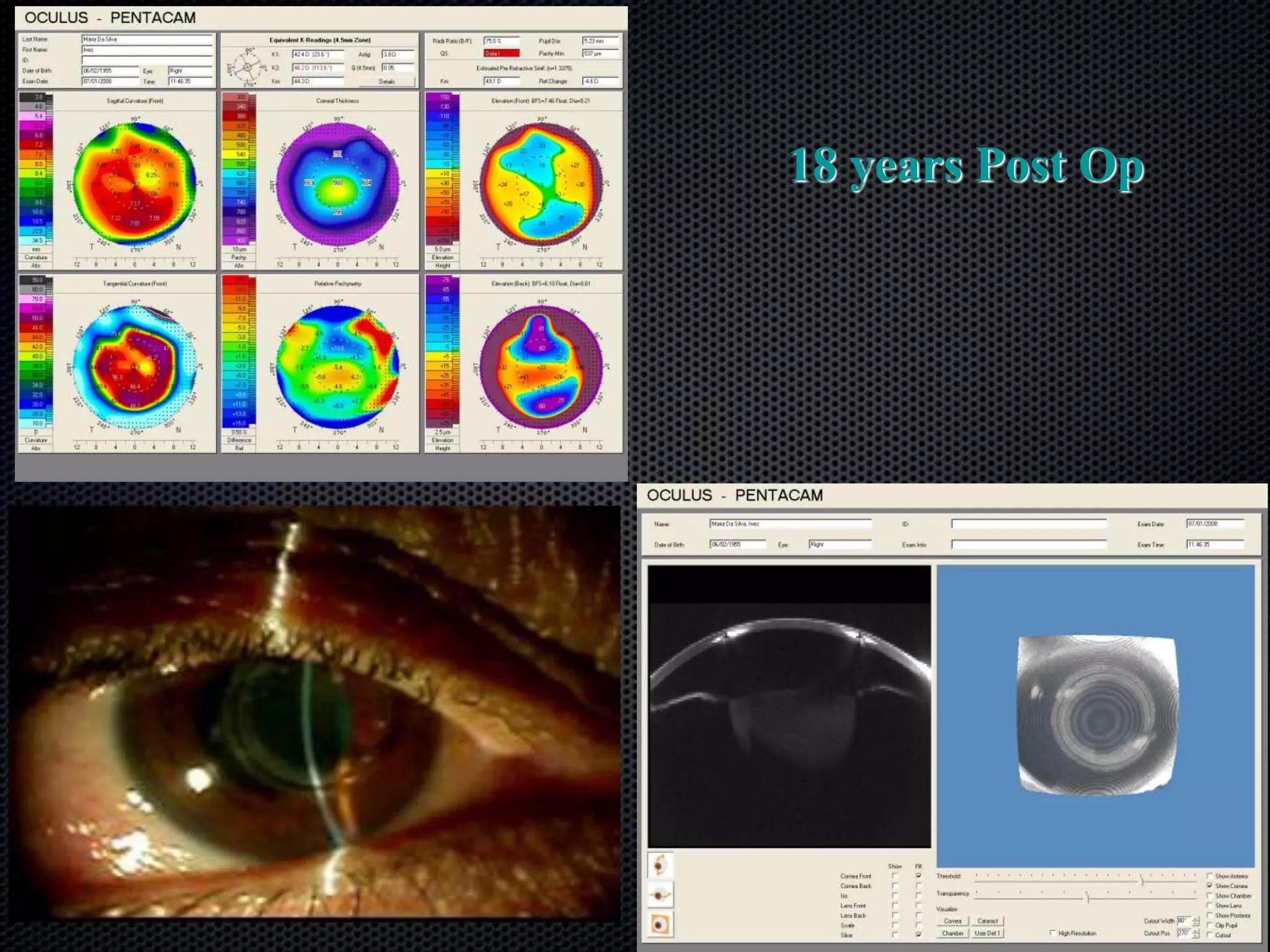 Ferrara Ring - 1st Red Sea Ophthalmology Symposium | PPTX