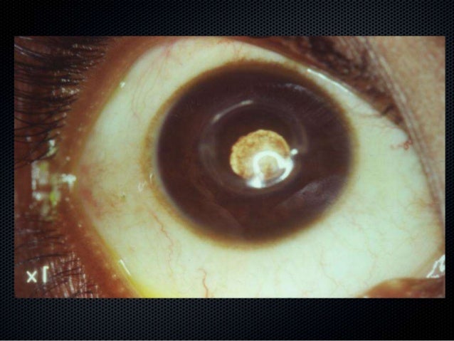 Ferrara Ring - 1st Red Sea Ophthalmology Symposium