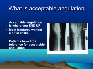 Rural Fracture Care | PPT