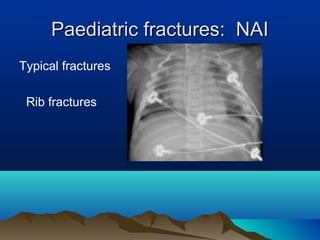 Rural Fracture Care | PPT