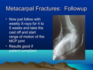 Rural Fracture Care | PPT