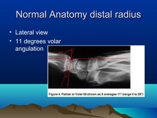 Rural Fracture Care | PPT