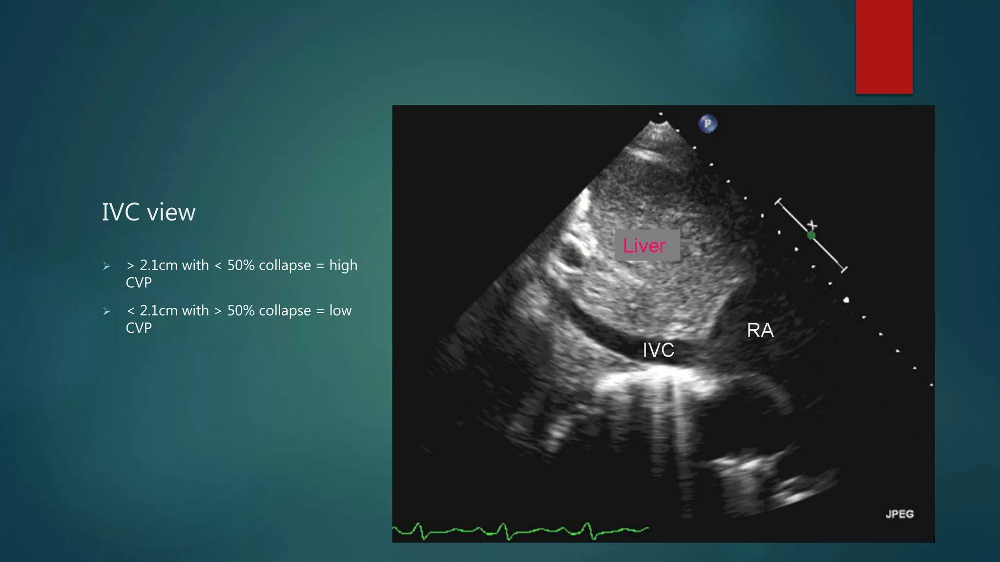 Use of bedside ultrasound in shock: RUSH protocol | PPTX