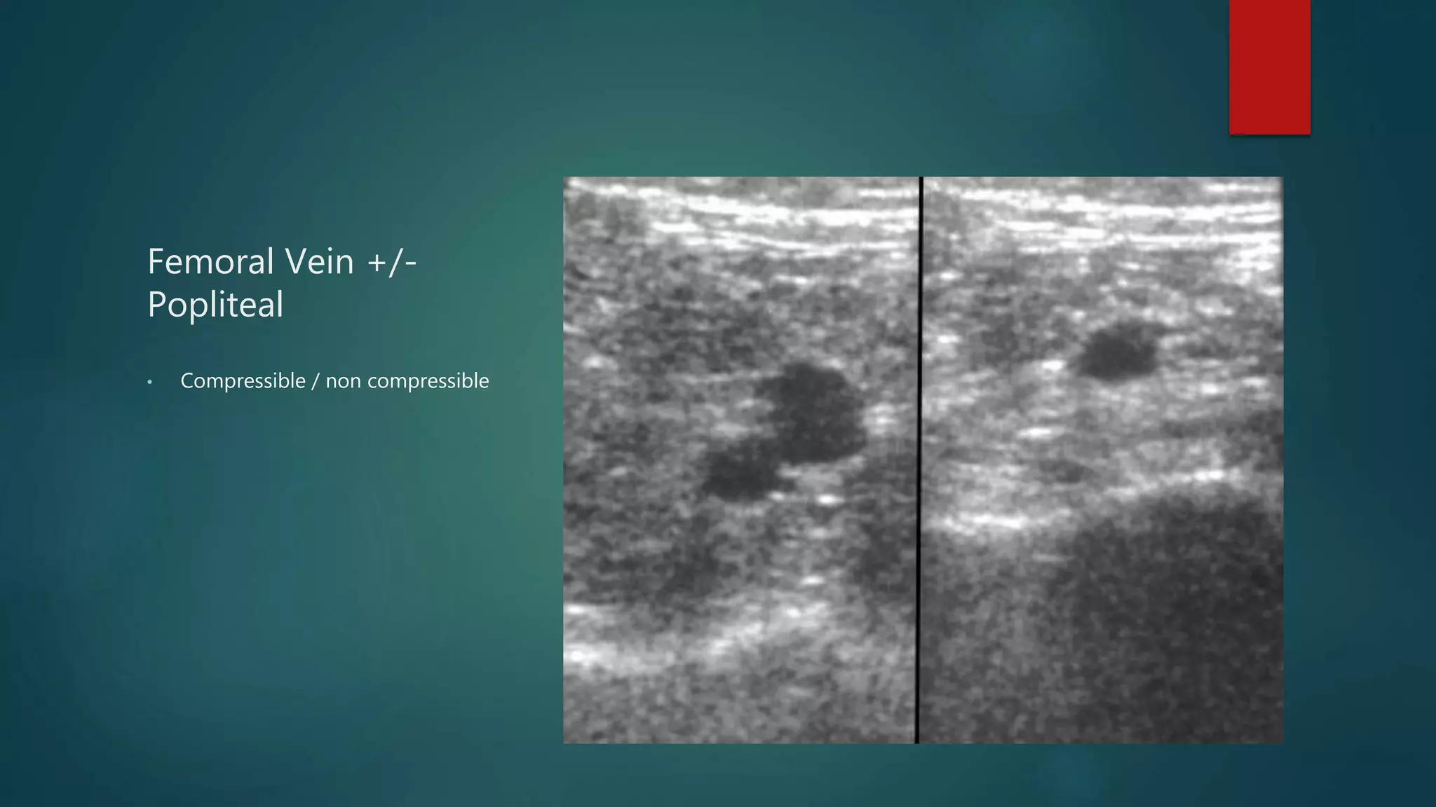 Use of bedside ultrasound in shock: RUSH protocol | PPTX
