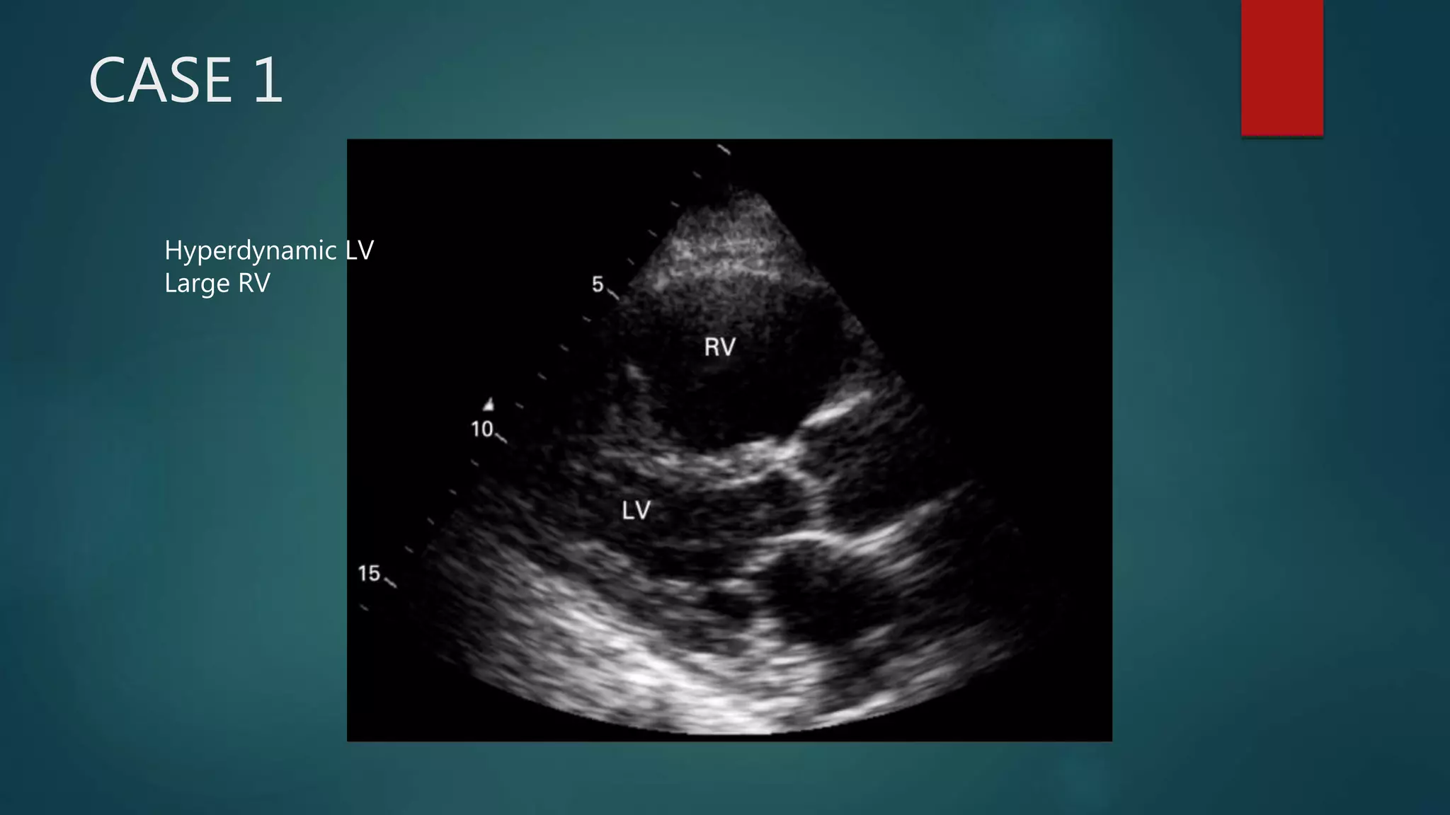 Use of bedside ultrasound in shock: RUSH protocol | PPTX