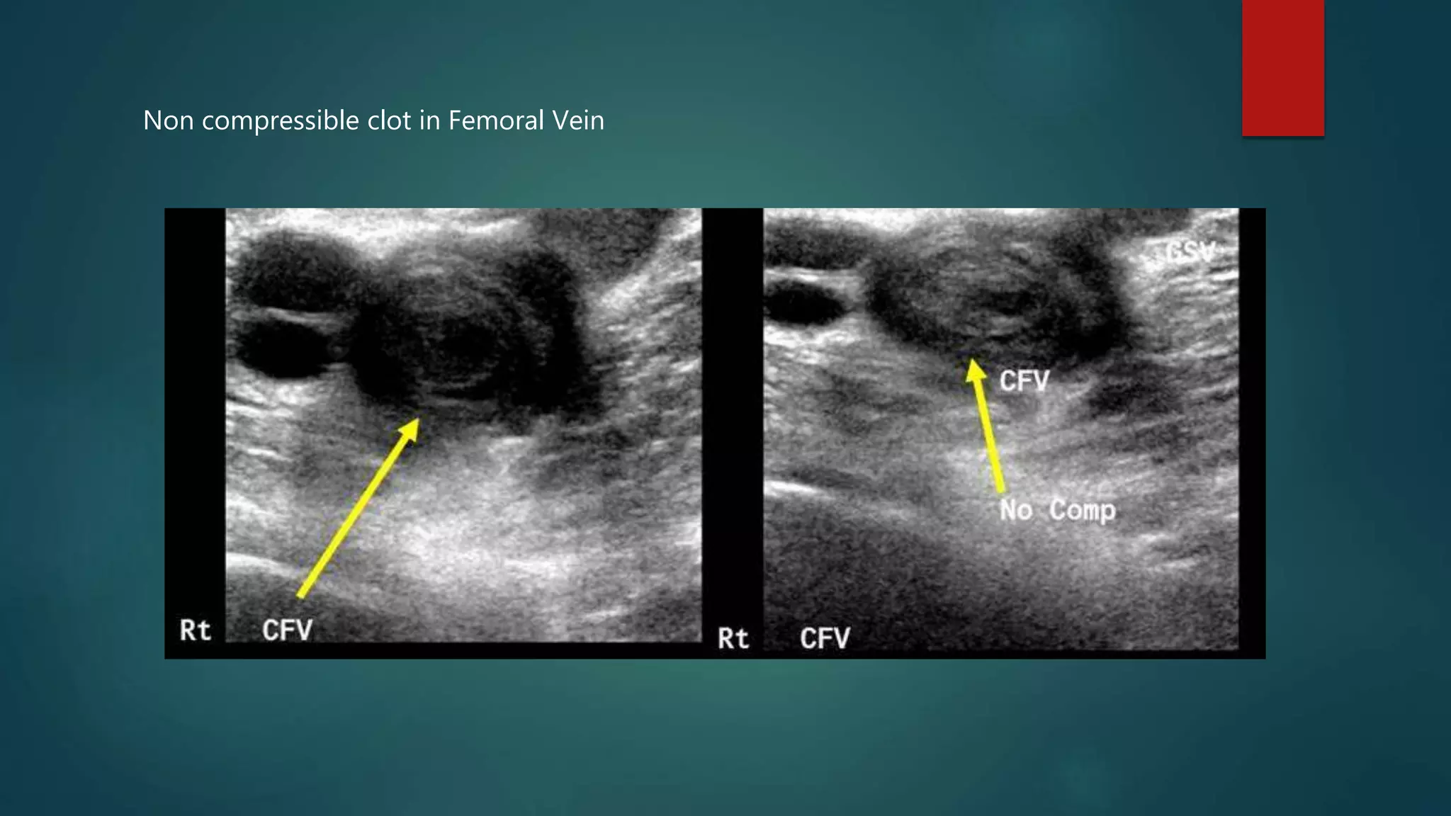 Use of bedside ultrasound in shock: RUSH protocol | PPTX