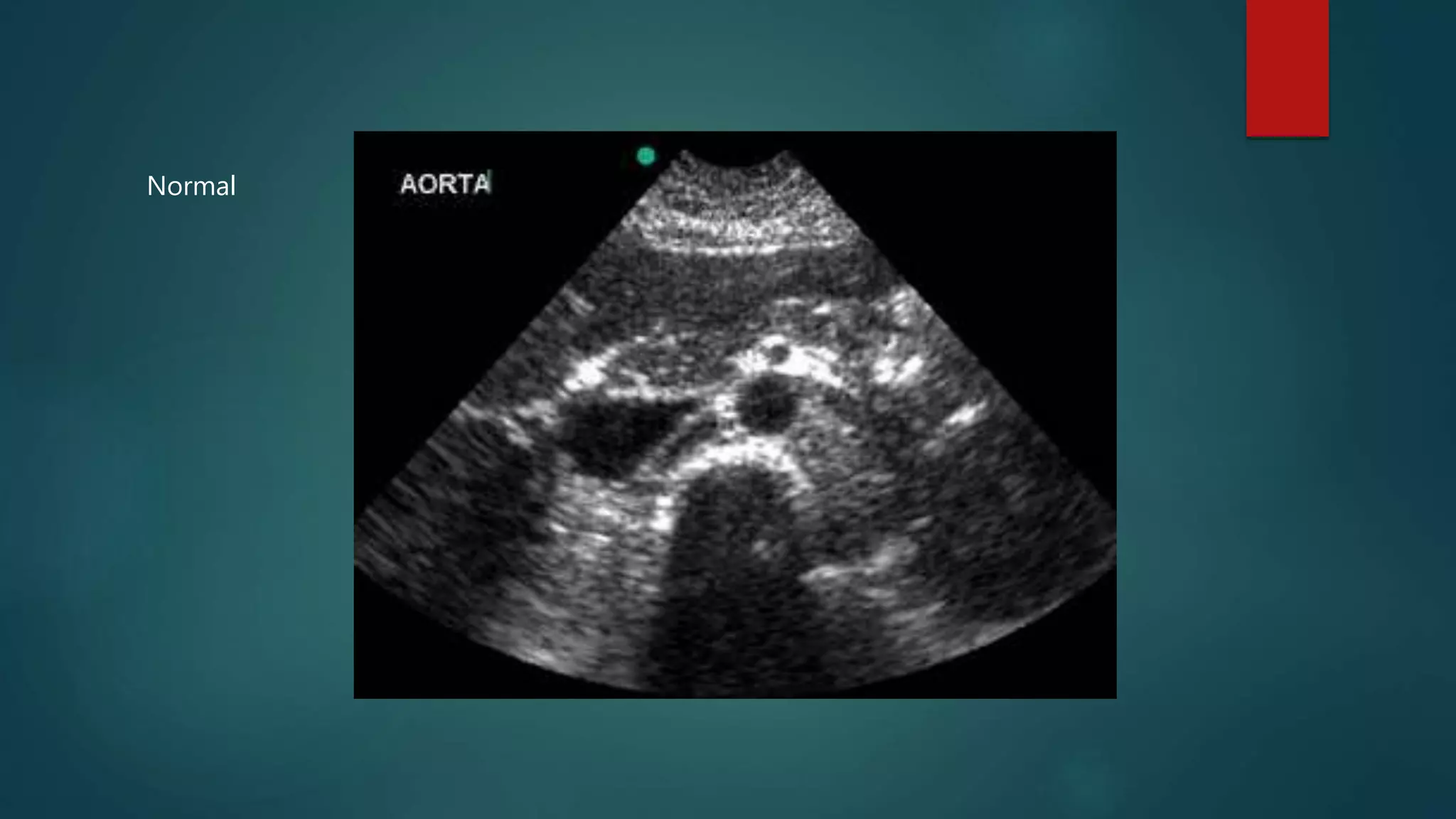 Use of bedside ultrasound in shock: RUSH protocol | PPTX