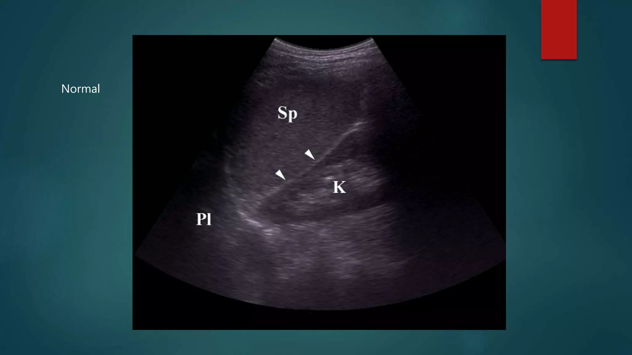 Use of bedside ultrasound in shock: RUSH protocol | PPTX