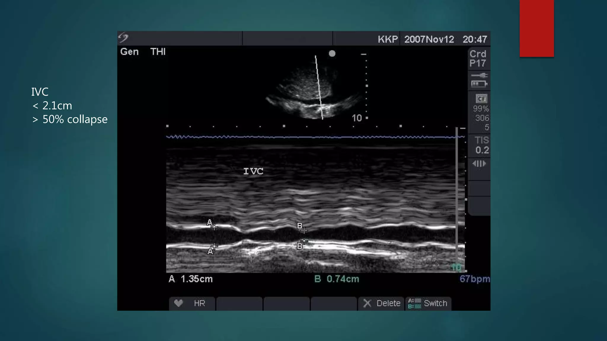 Use of bedside ultrasound in shock: RUSH protocol | PPTX