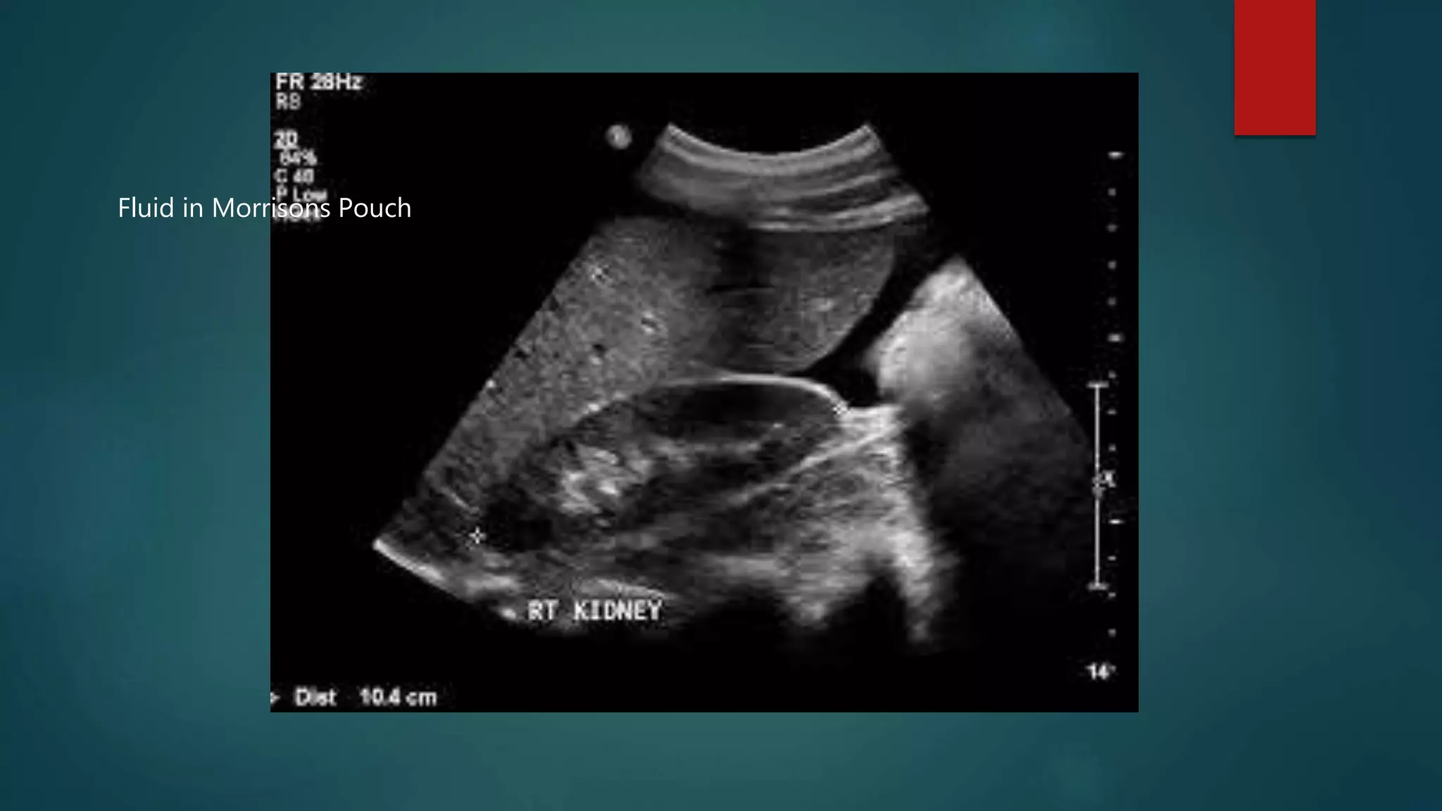 Use of bedside ultrasound in shock: RUSH protocol | PPTX
