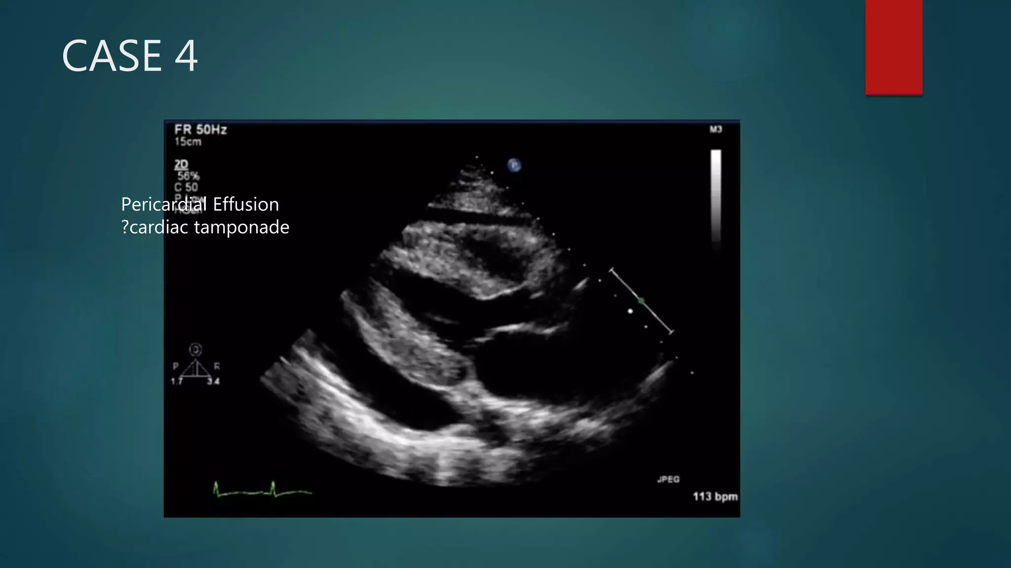Use of bedside ultrasound in shock: RUSH protocol | PPTX