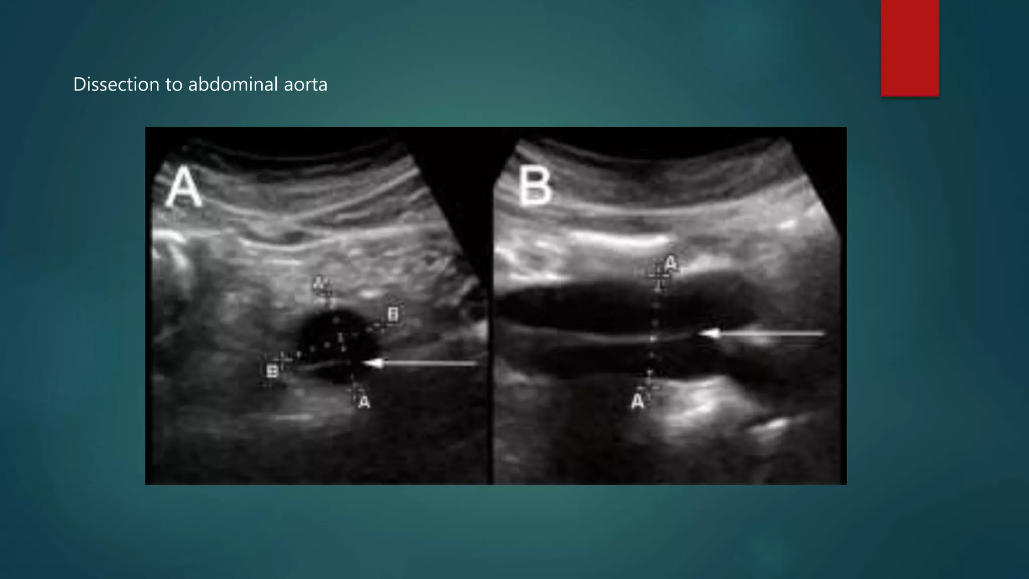 Use of bedside ultrasound in shock: RUSH protocol | PPTX