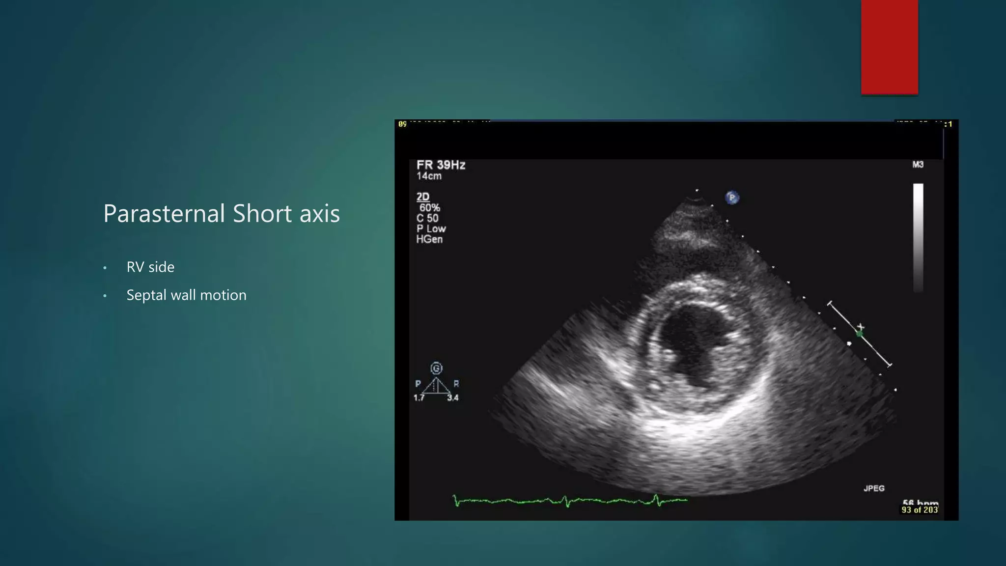 Use of bedside ultrasound in shock: RUSH protocol | PPTX