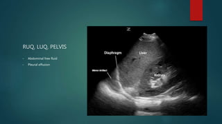 Use of bedside ultrasound in shock: RUSH protocol | PPTX