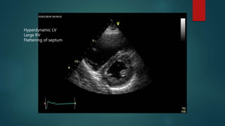 Use of bedside ultrasound in shock: RUSH protocol | PPTX