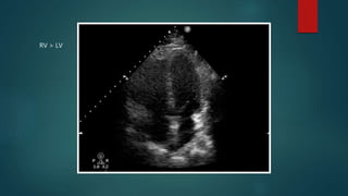 Use of bedside ultrasound in shock: RUSH protocol | PPTX