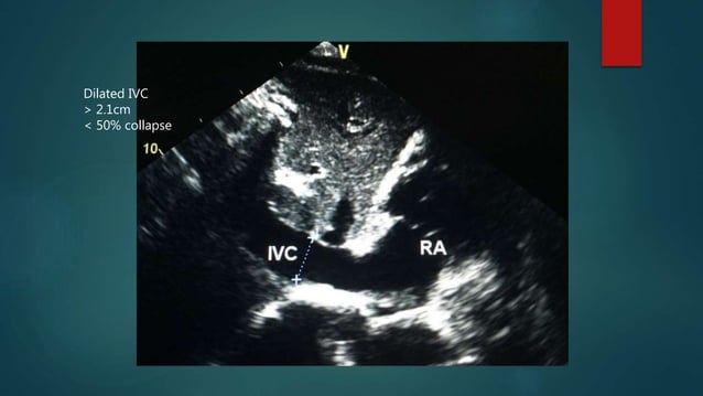 Use of bedside ultrasound in shock: RUSH protocol | PPTX | Death ...