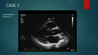 Use of bedside ultrasound in shock: RUSH protocol | PPTX
