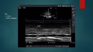 Use of bedside ultrasound in shock: RUSH protocol | PPTX
