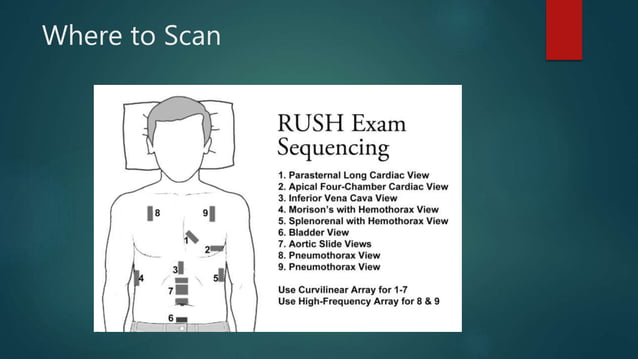 Use of bedside ultrasound in shock: RUSH protocol | PPTX | Death ...